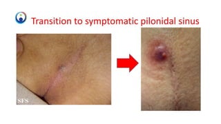 Sinus pilonidalis lokale behandeling en nieuwe richtlijn | PPT