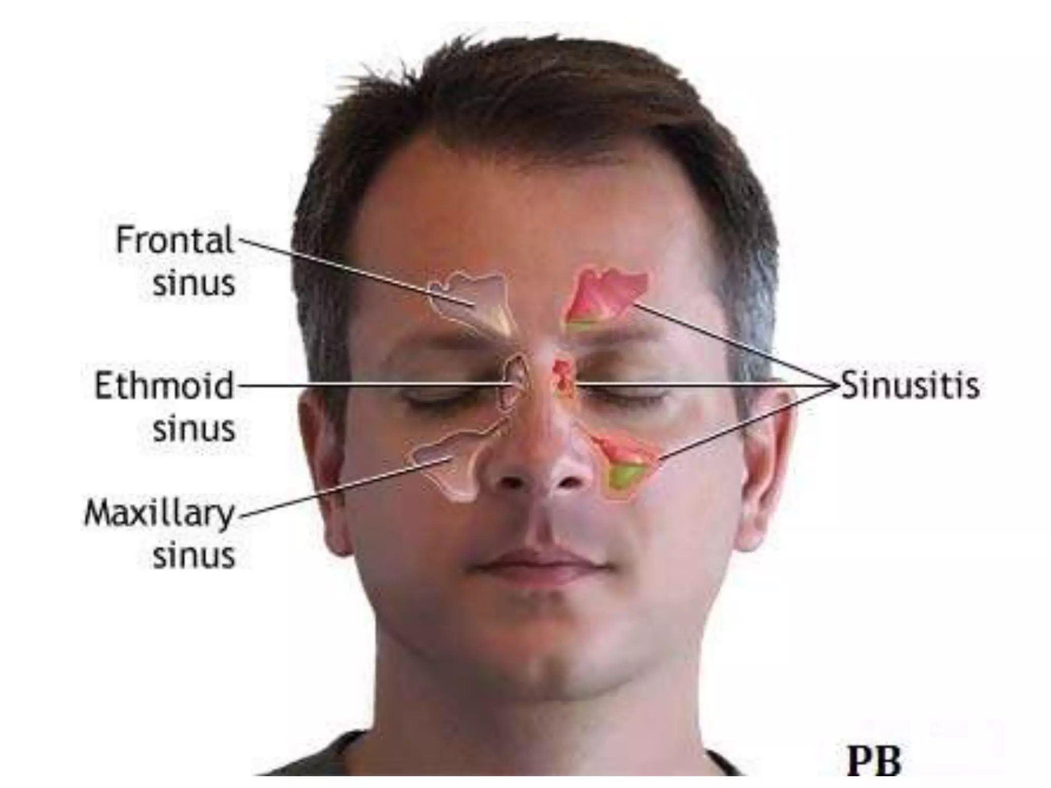 Sinus pressure points | PPTX