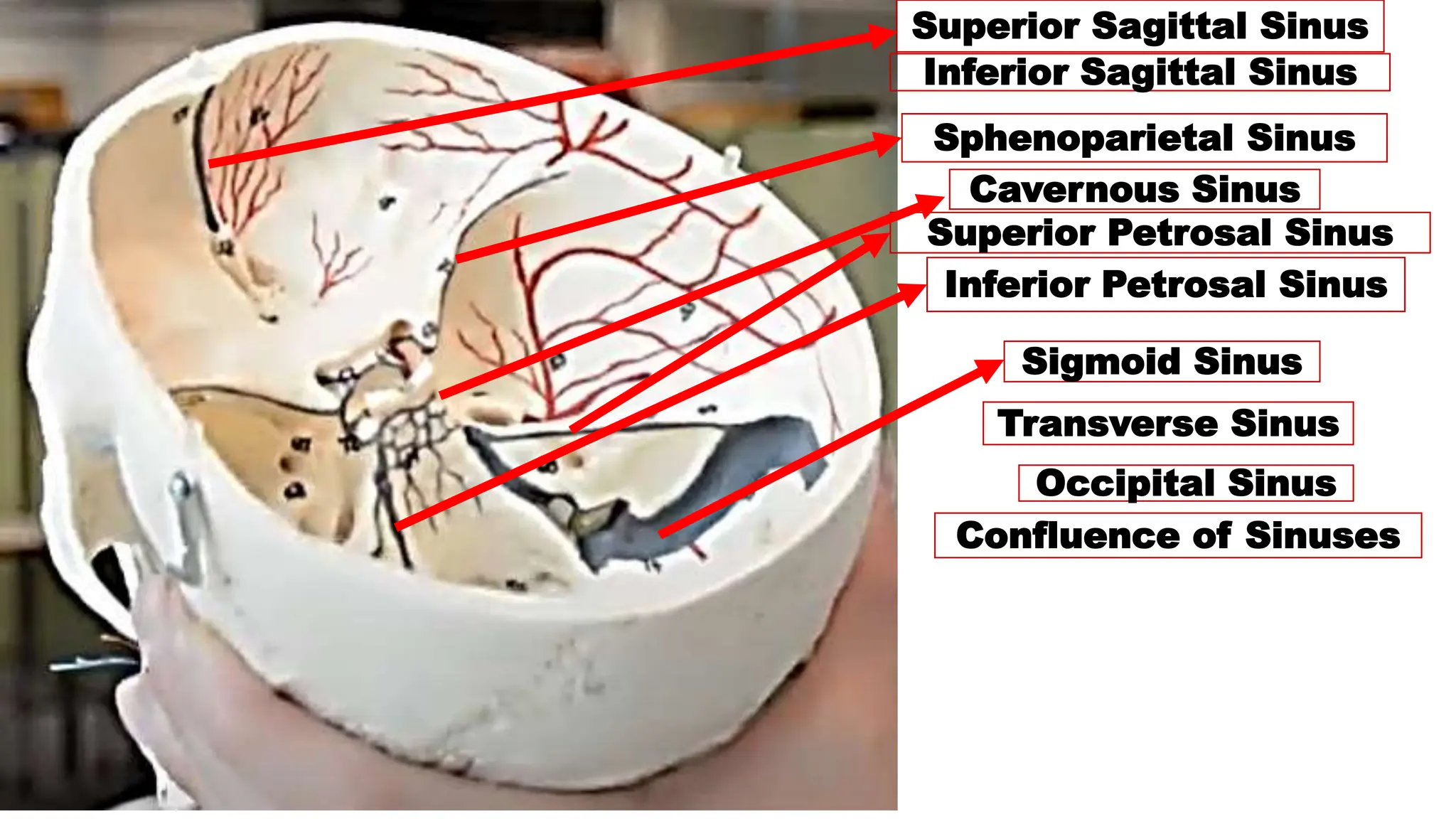 Dura Venous Sinus Skull Model OSPE Model.pptx