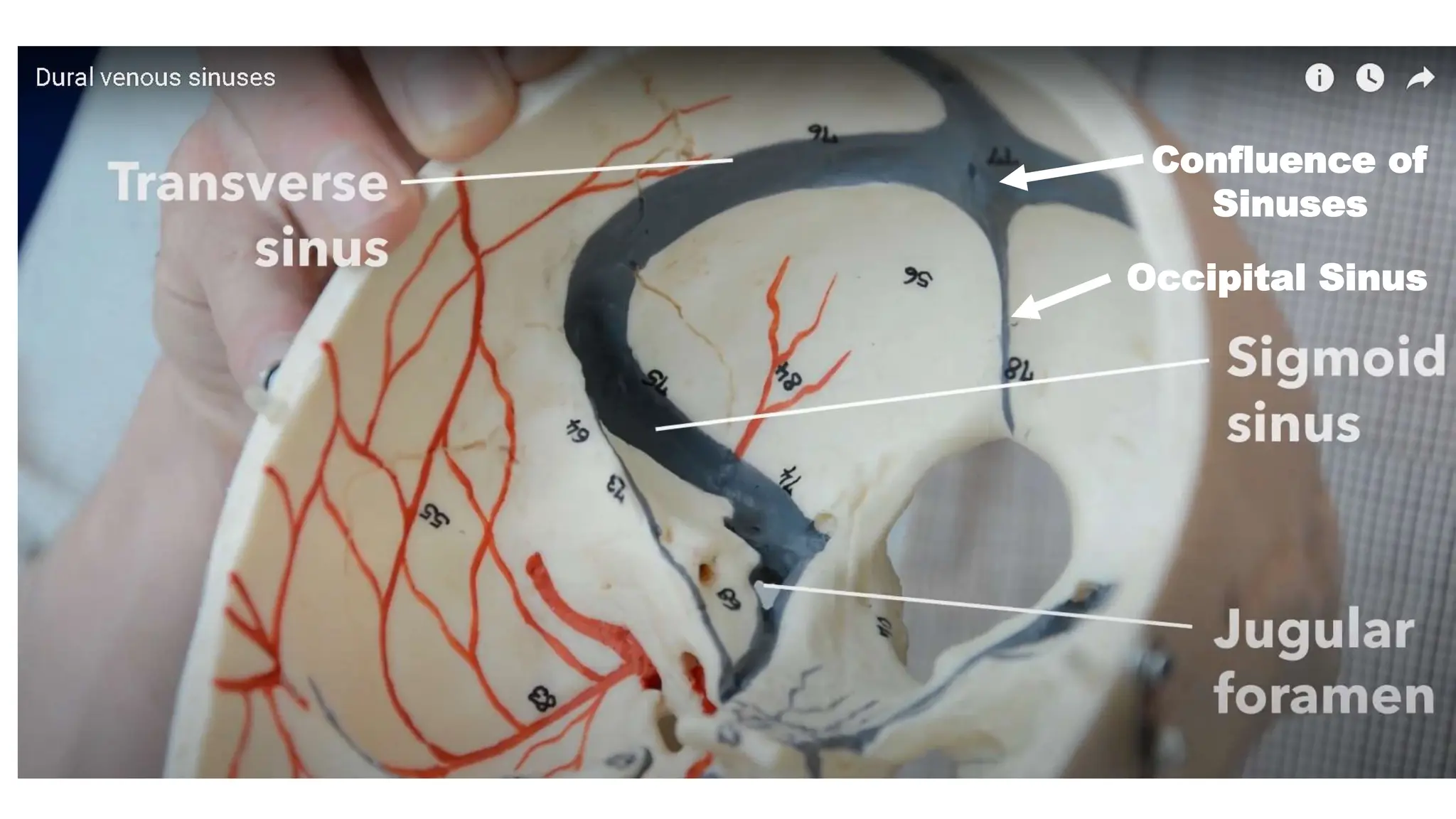 Dura Venous Sinus Skull Model OSPE Model.pptx