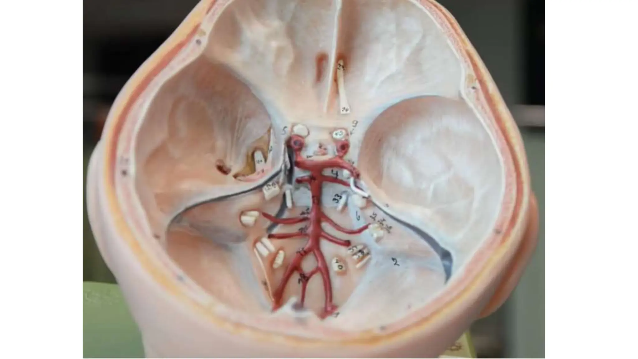Dura Venous Sinus Skull Model OSPE Model.pptx