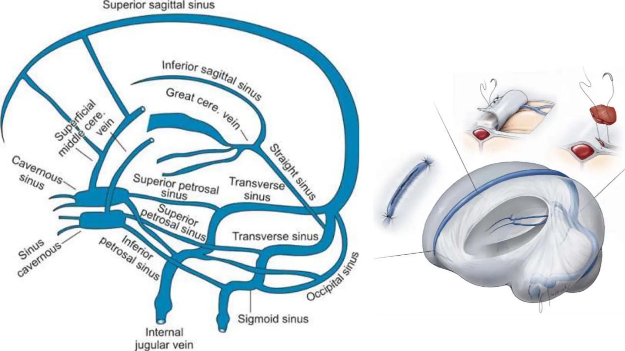 Dura Venous Sinus Skull Model OSPE Model.pptx