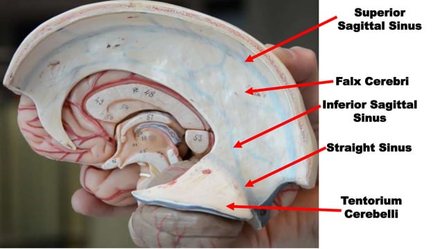 Dura Venous Sinus Skull Model OSPE Model.pptx