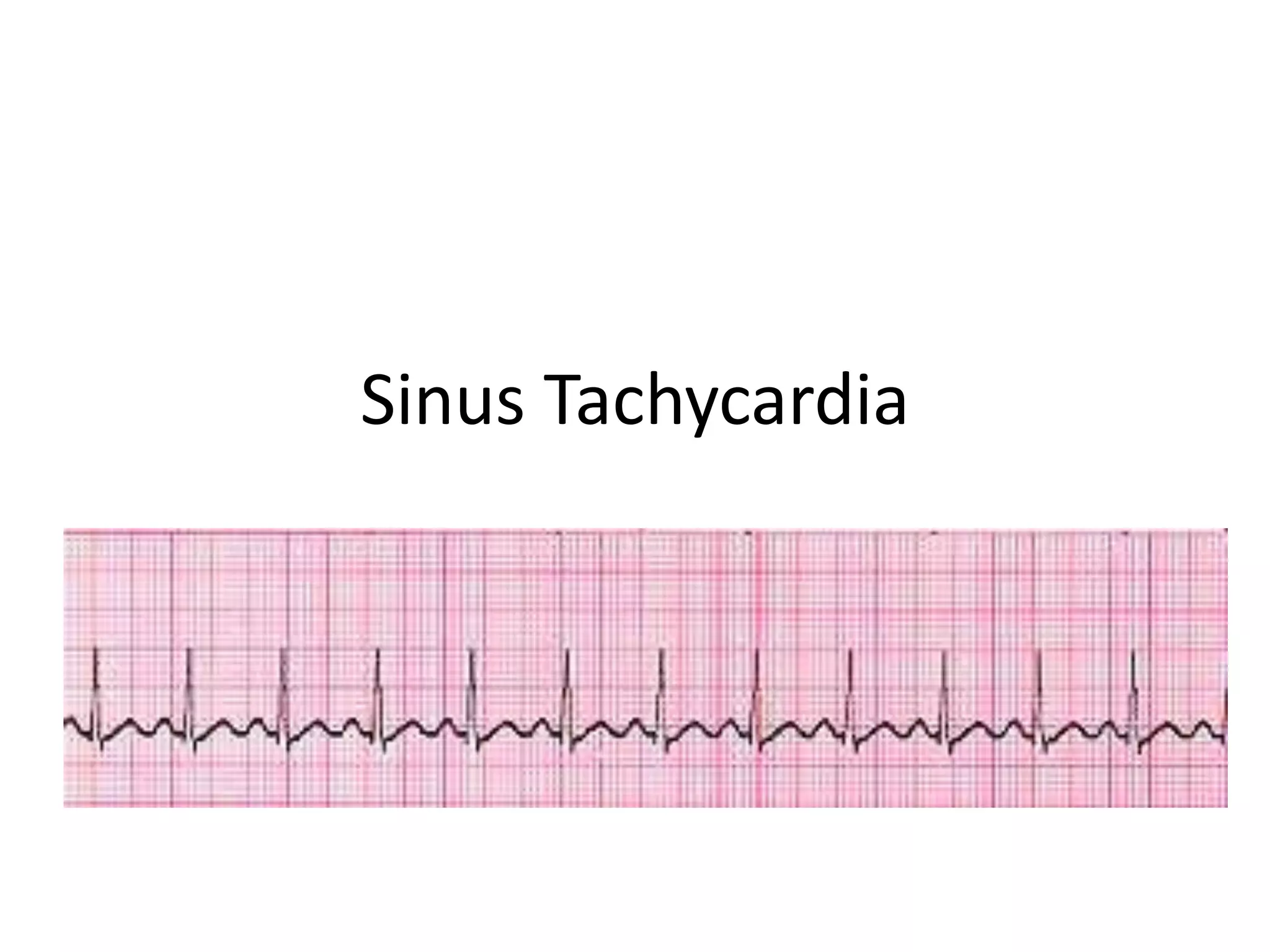 Sinus tachycardia | PPTX