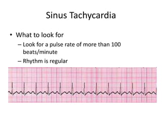 Sinus tachycardia | PPTX