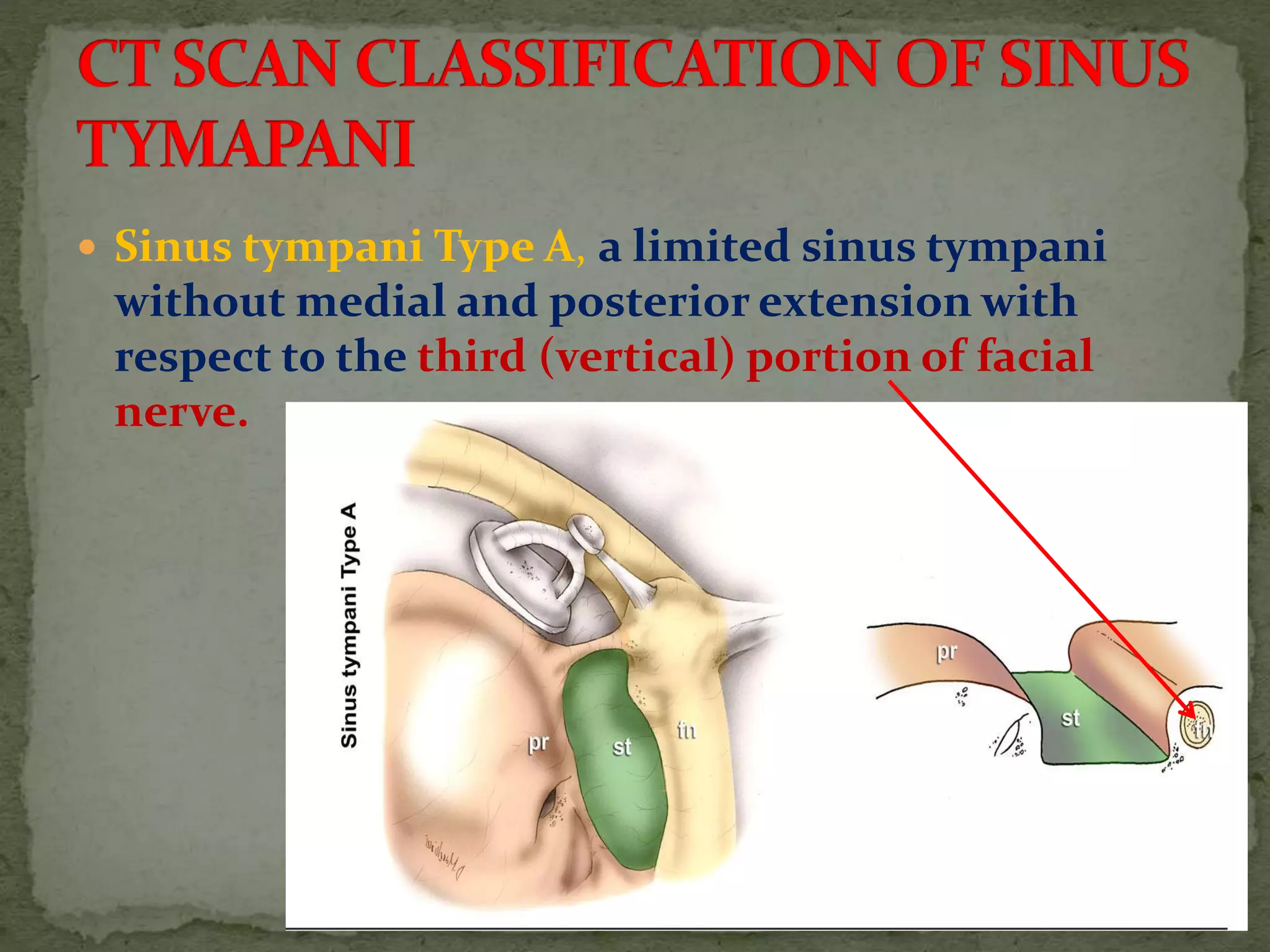 Sinus tympani prof dr bikash | PPT