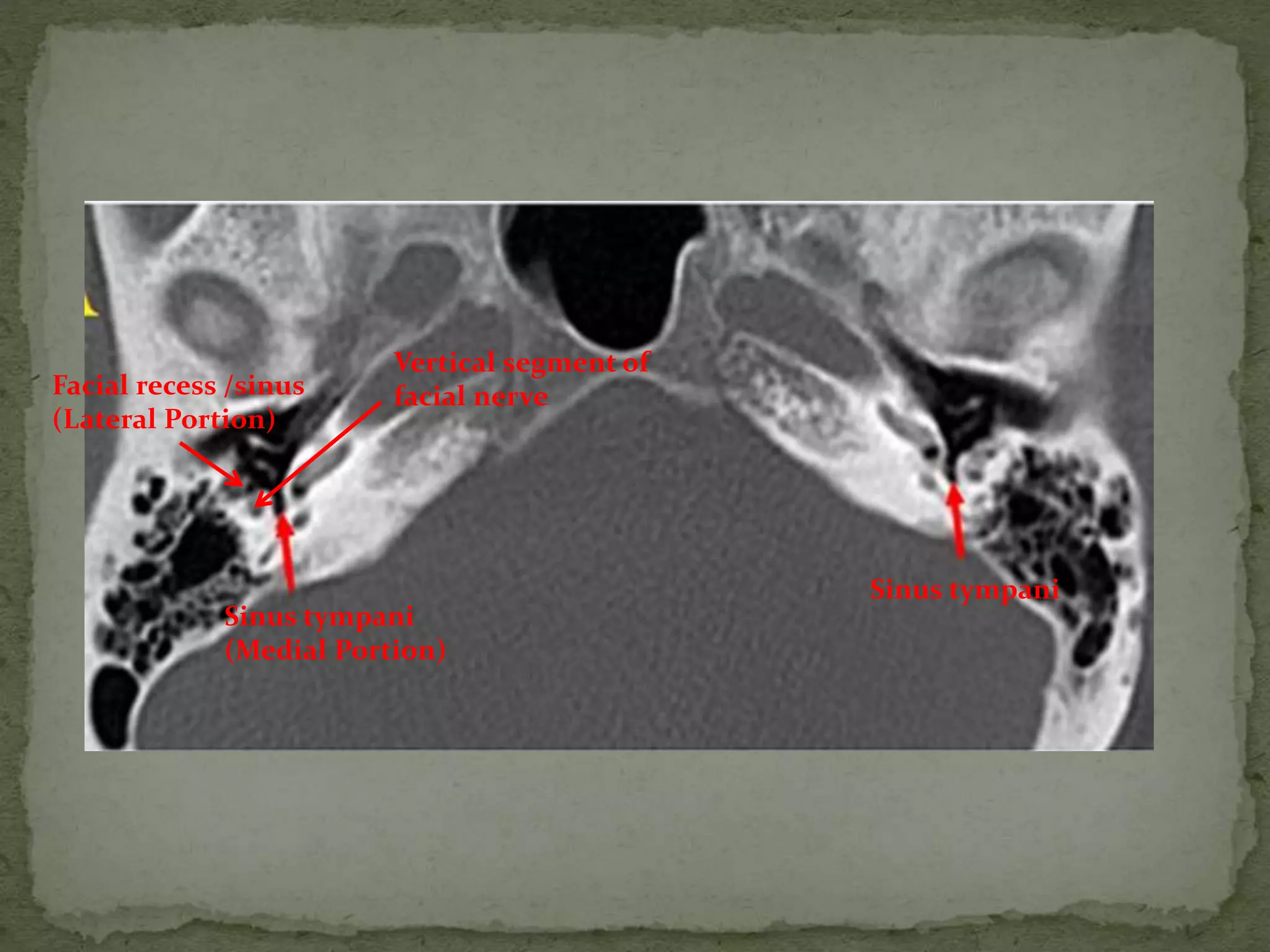 Sinus tympani prof dr bikash | PPT