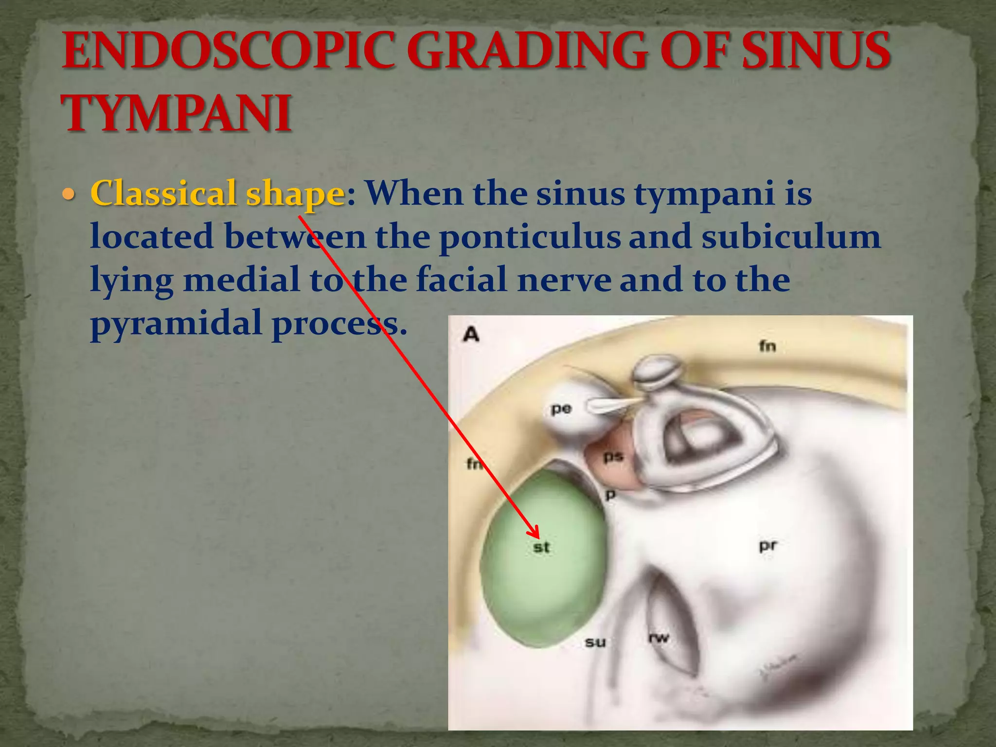 Sinus tympani prof dr bikash | PPT