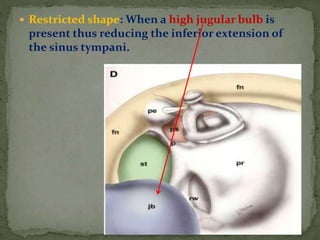 Sinus tympani prof dr bikash | PPT