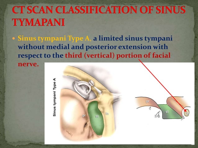 Sinus tympani prof dr bikash | PPT | Classical Music | Music