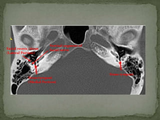 Sinus tympani prof dr bikash | PPT