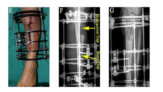 L- shaped Corticotomy - osteomyelitis | PPT