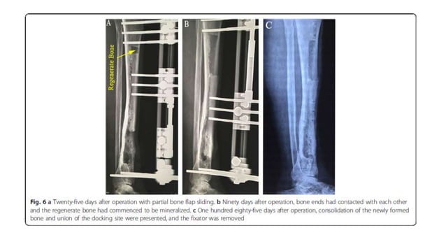 L- shaped Corticotomy - osteomyelitis | PPT