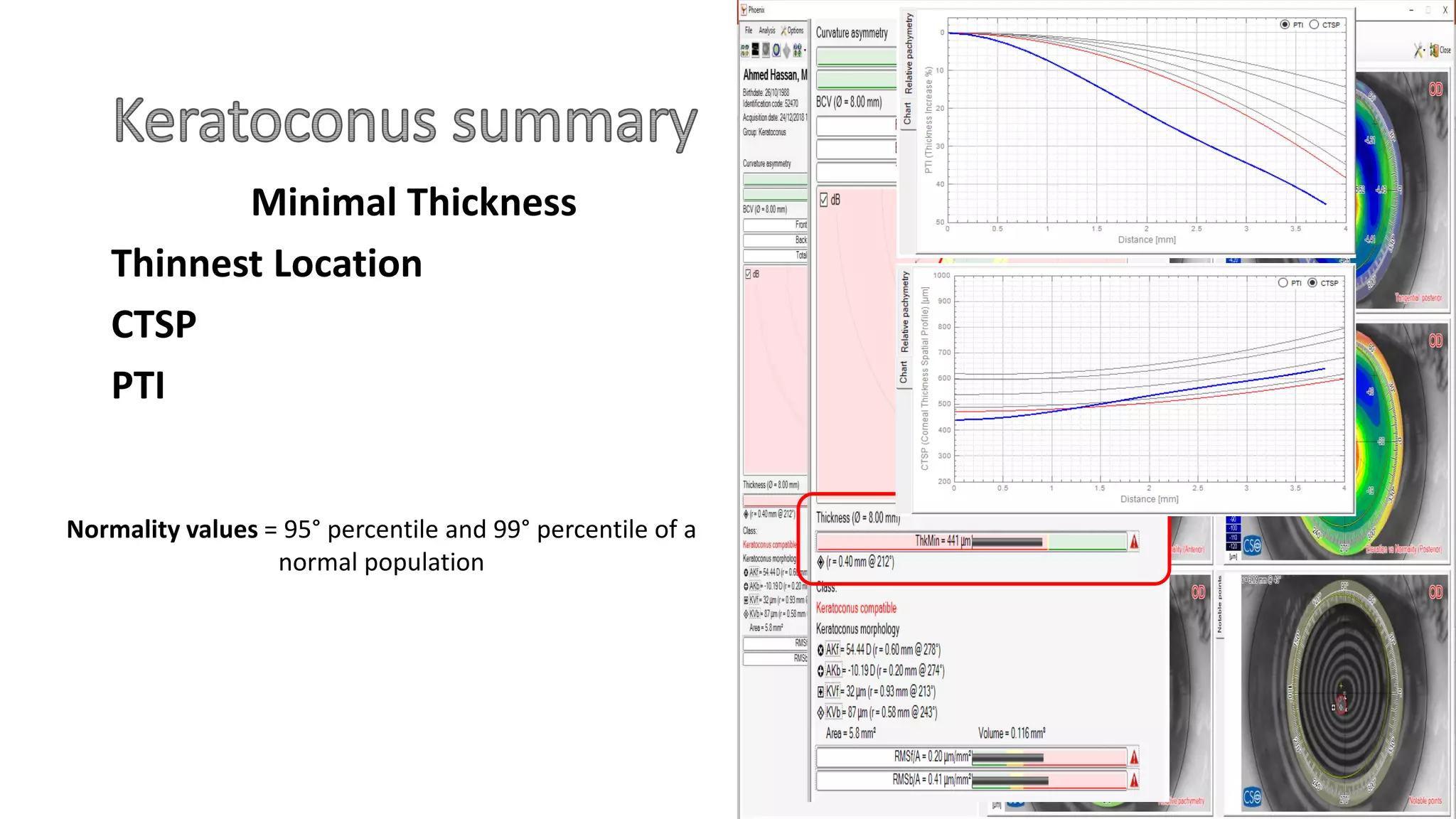 Sirius CSO The other face of Pentacam | PDF