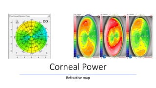 Sirius CSO The other face of Pentacam | PDF