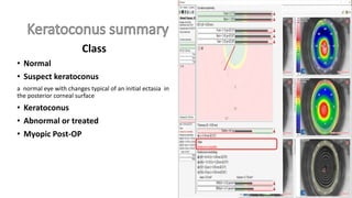 Sirius CSO The other face of Pentacam | PDF