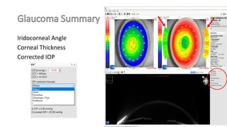 Sirius CSO The other face of Pentacam | PDF