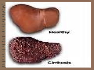 tutorial-Sirosis hepatis | PPT