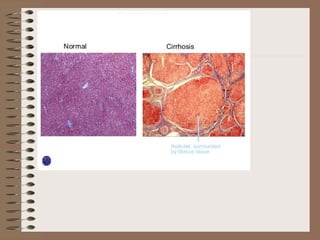 tutorial-Sirosis hepatis | PPT
