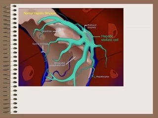 tutorial-Sirosis hepatis | PPT