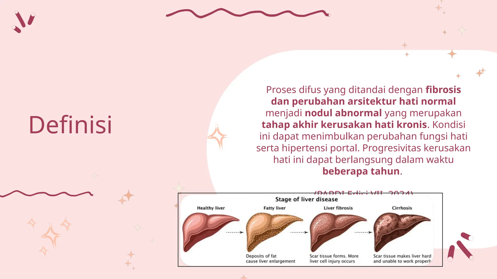 sirosis hepatis sirosis hepatis sirosiss | PPTX