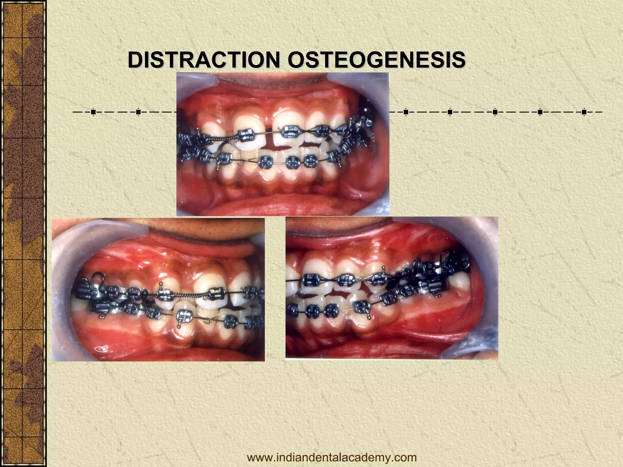 orthodontic perspective of distraction osteogenesis | PPT
