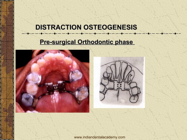 Orthodontic Perspective Of Distraction Osteogenesis Ppt