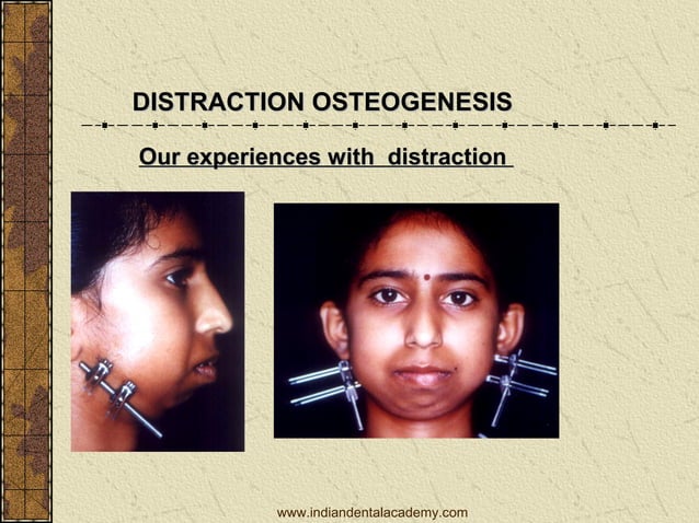 orthodontic perspective of distraction osteogenesis | PPT