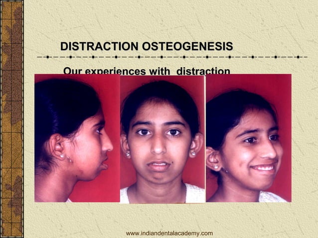 orthodontic perspective of distraction osteogenesis | PPT