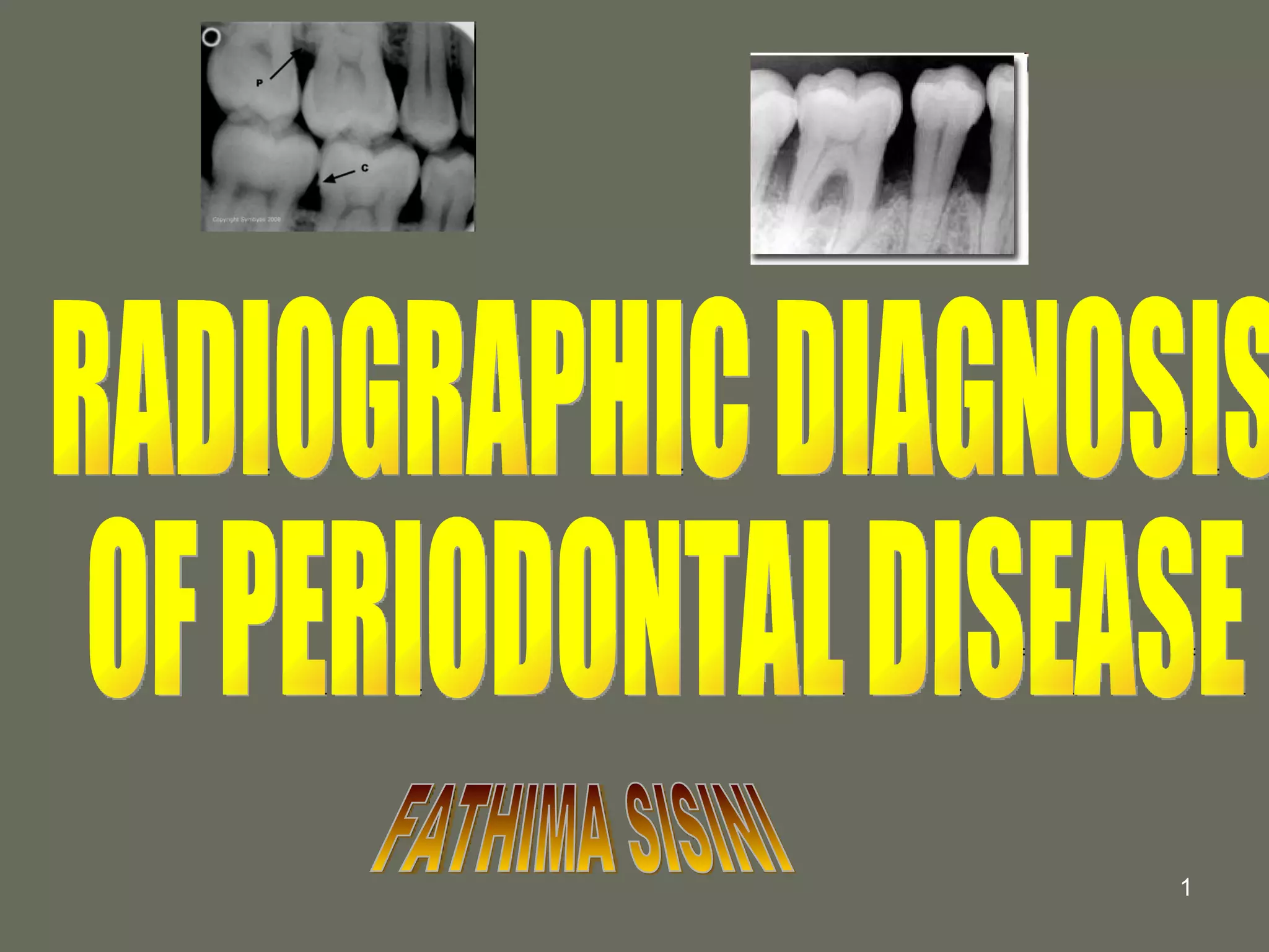 radiographic diagnosis of periodontal disease | PPT