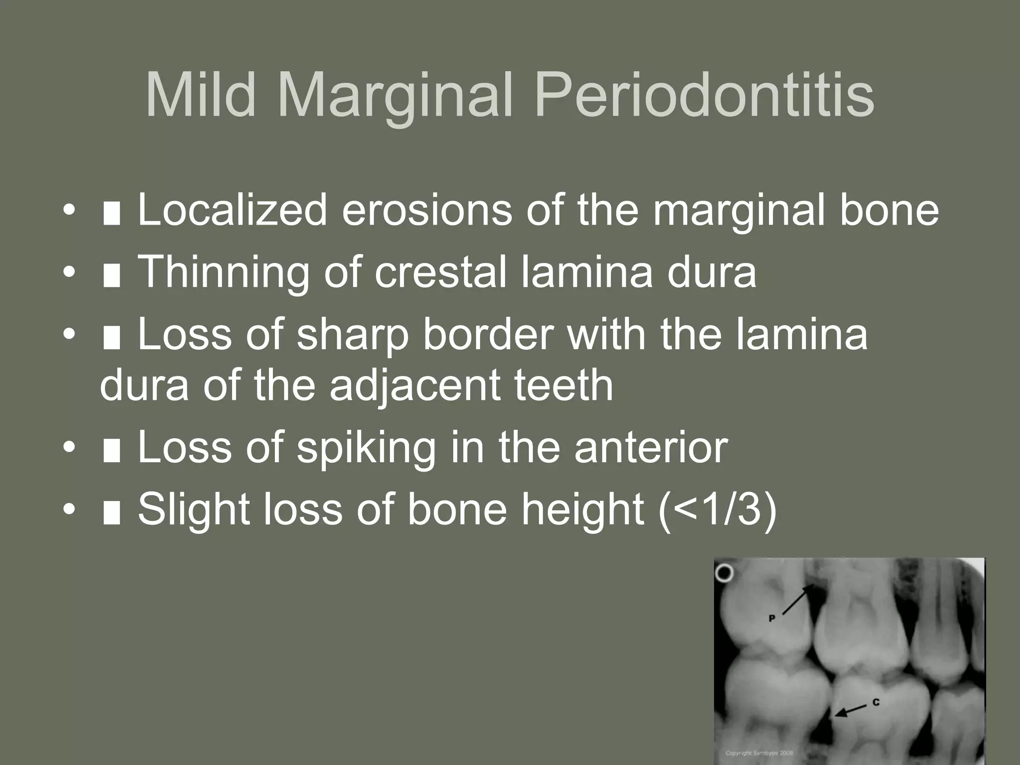 radiographic diagnosis of periodontal disease | PPT