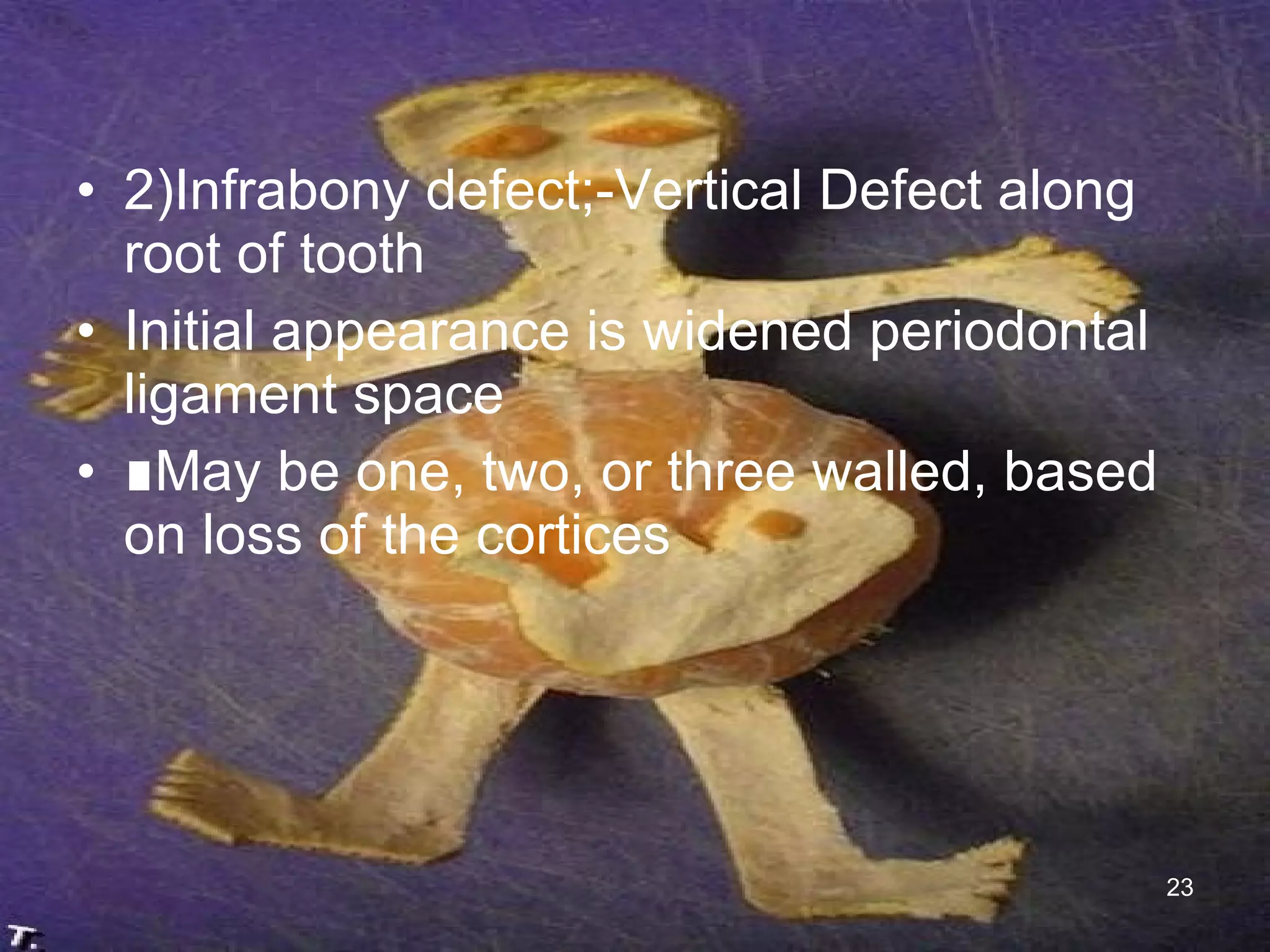 radiographic diagnosis of periodontal disease | PPT