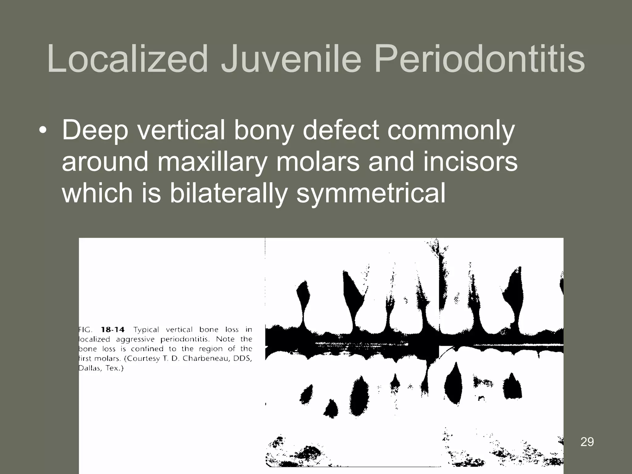 radiographic diagnosis of periodontal disease | PPT