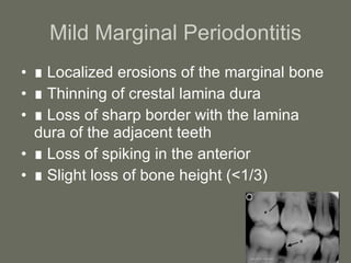 Moderate Periodontitis Radiograph