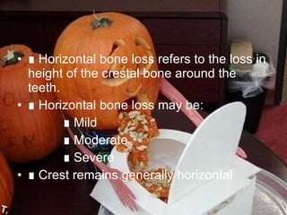 radiographic diagnosis of periodontal disease | PPT