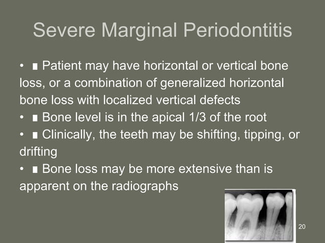 radiographic diagnosis of periodontal disease | PPT | Bone and Joint ...