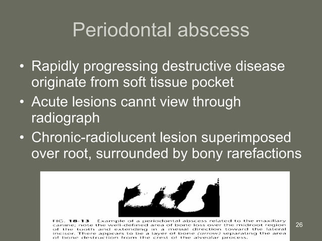 radiographic diagnosis of periodontal disease | PPT | Bone and Joint ...