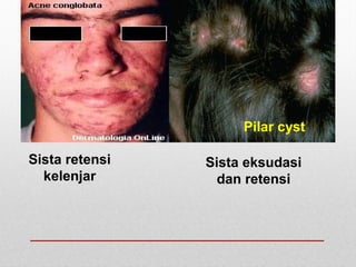 SISTA ( CYST ) | PPT