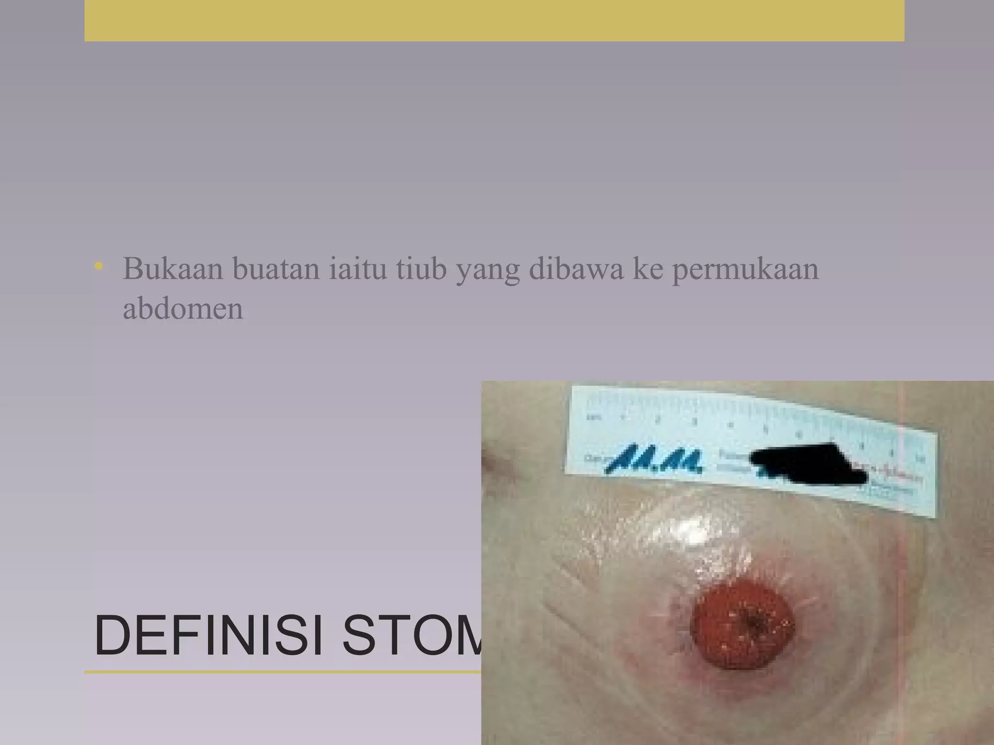 SISTEM ALIMENTARI - Penjagaan Kolostomi dan Irigasi Stoma | PPT