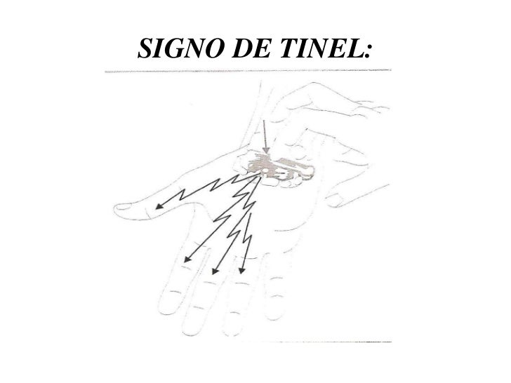 Sign Tinel Phalen Og Ppt Powerpoint Presentation Sketch Coloring Page