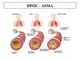 Sistema Respiratório_DPOC caracterização | PPTX