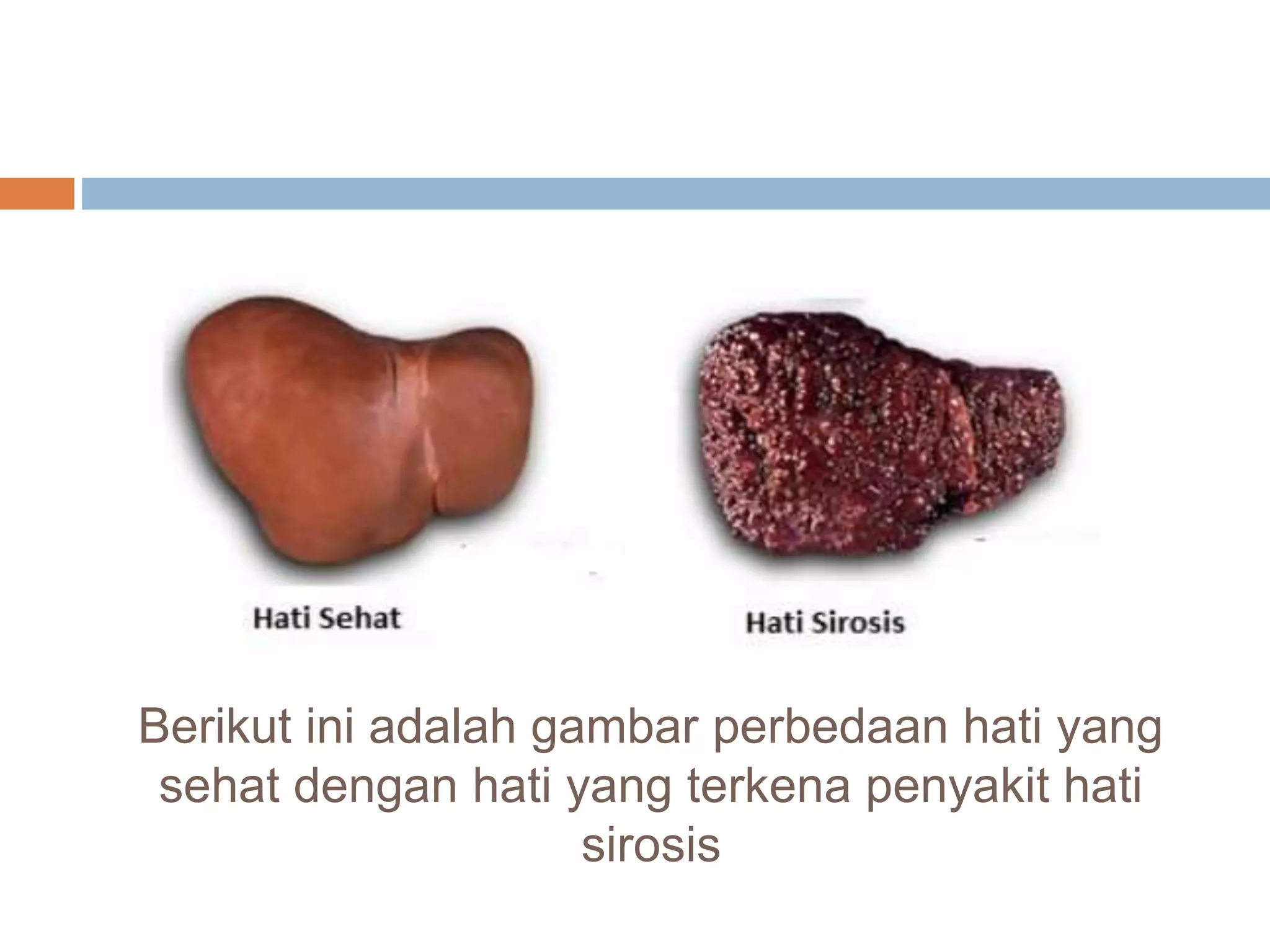Sistem ekskresi hati | PPTX