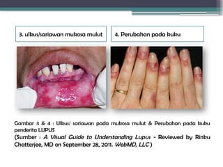sistemik_lupus_eritomatosisssssssss.pptx