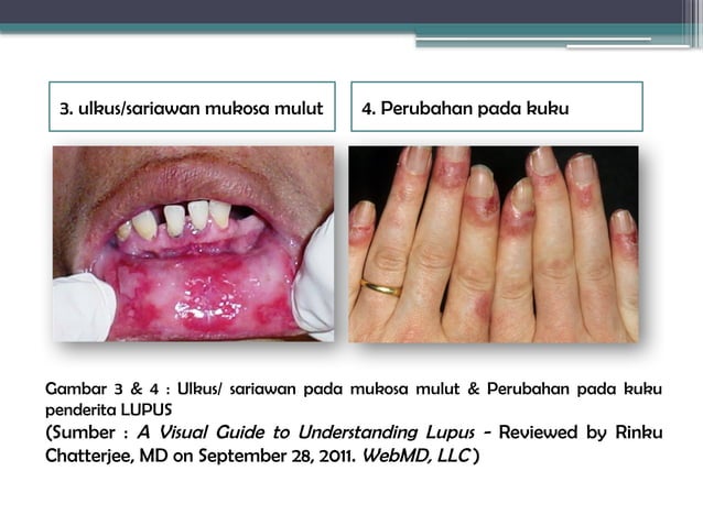 sistemik_lupus_eritomatosisssssssss.pptx