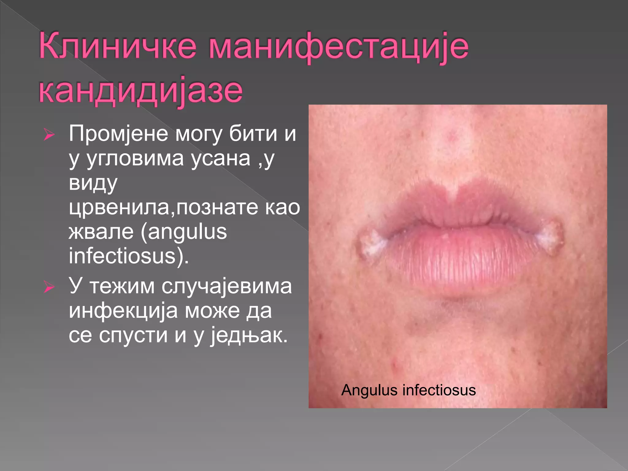 Sistemne mikoze | PPTX