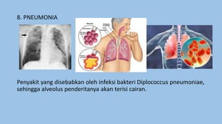 Sistem pernafasan manusia gangguan pernapasan kelas 8 | PPTX