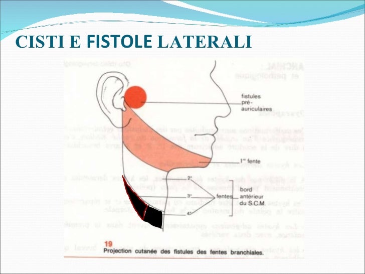 Cisti Congenite della testa e del collo