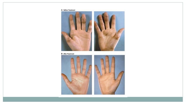 Sitosterolemia | PDF | Digestive Disorders | Diseases and Conditions