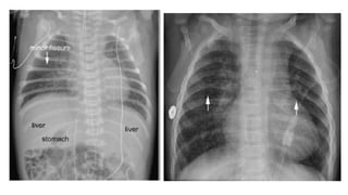 Situs anomalies presentation for Radiology | PPTX