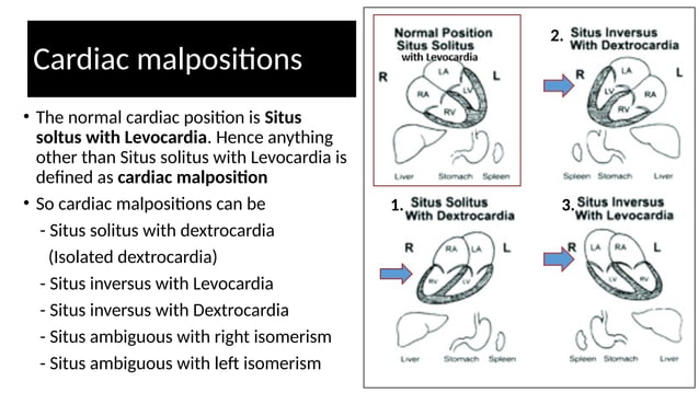 Situs anomalies presentation for Radiology | PPTX